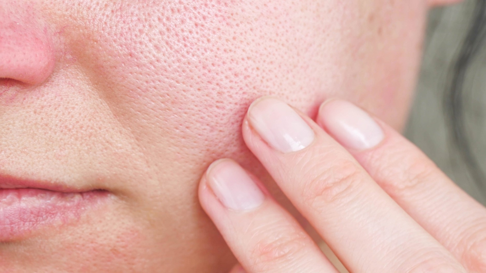 Enlarged Pores